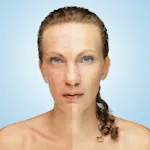 Acne Prone? Keto or Low Carb Diets Can Help — Diet Doctor