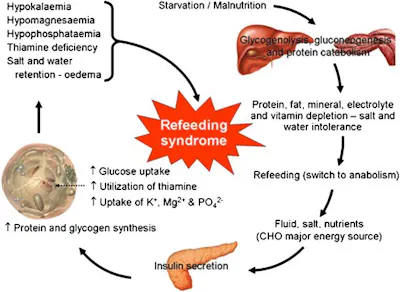 Fasting and re-feeding syndrome - Diet Doctor